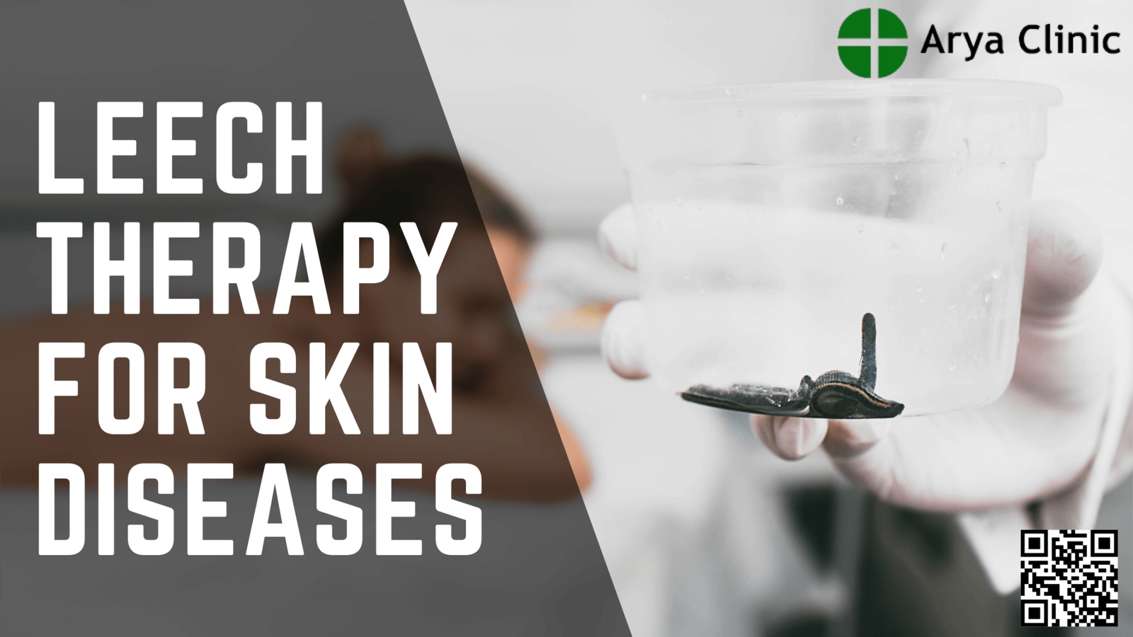 Leech Therapy for Skin Diseases | Arya Clinic